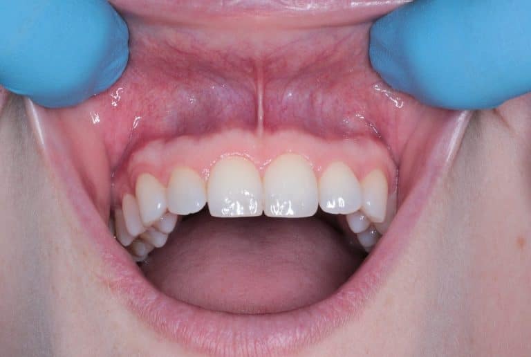 Diente - Qué es, definición y concepto