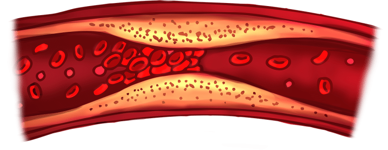 Trombo - Qué es, definición, causas y tipos