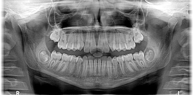Oclusión - Qué es, tipos, definición y concepto