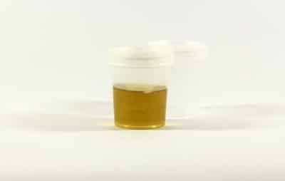Oliguria - Qué es, definición, causas y clasificación