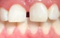 Encía - Qué es, definición y concepto